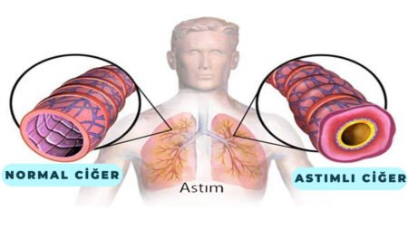 Zespira Nedir? Yan Etkileri Nelerdir? Astım Tedavisi