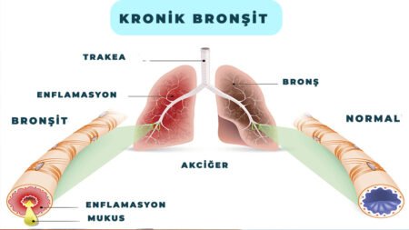 İnfex 200 mg Ne İçin Kullanılır? Güncel Fiyatı Ne Kadar?