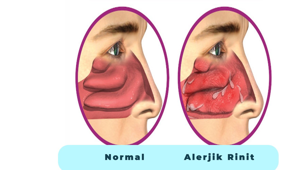 Levmont 5 10 mg Nedir Ne İşe Yarar ? Güncel Fiyatı Ne Kadar?