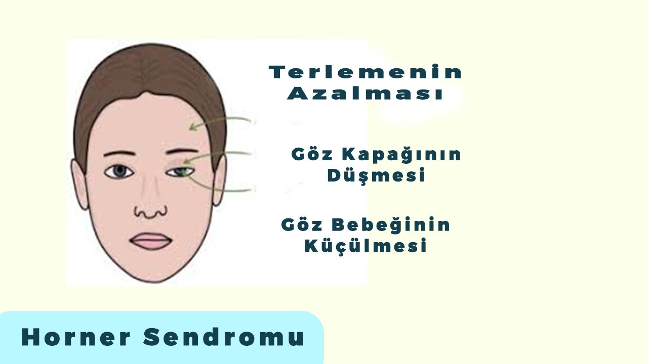 Horner Sendromu Nedir? Nedenleri Nelerdir?